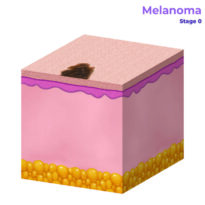 Stages of Melanoma - AIM at Melanoma Foundation
