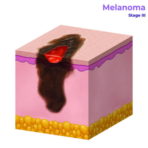 Stages of Melanoma - AIM at Melanoma Foundation