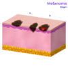 Stages of Melanoma - AIM at Melanoma Foundation