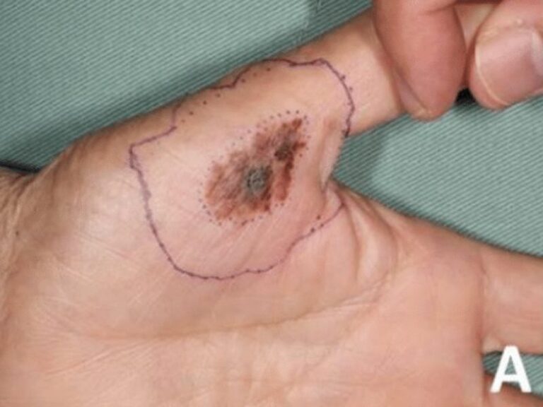 Images of Melanoma in People with Skin of Color - AIM at Melanoma ...