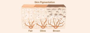 Melanoma in Skin of Color - AIM at Melanoma Foundation