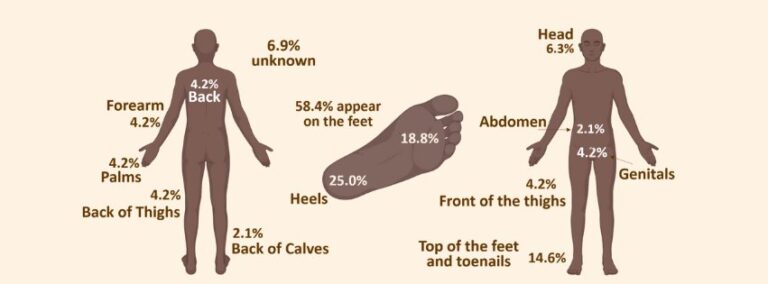 Melanoma in Skin of Color - AIM at Melanoma Foundation