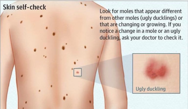 Know Your ABCDEs - AIM at Melanoma Foundation