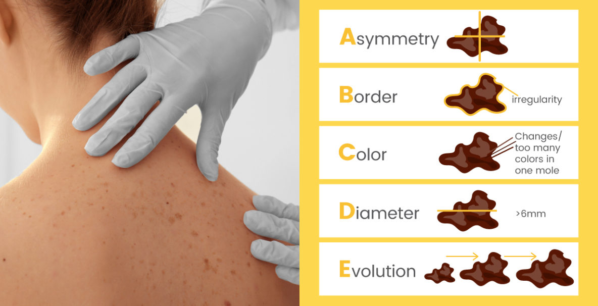 When To Contact Your Doctor - AIM at Melanoma Foundation