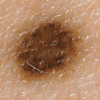 Types of Moles and Skin Lesions - AIM at Melanoma Foundation