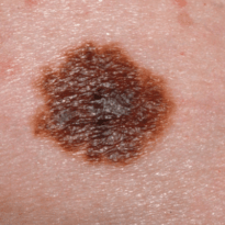 Types of Moles and Skin Lesions - AIM at Melanoma Foundation