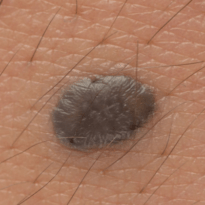 Arten von Muttermalen und Hautläsionen - AIM bei der Melanoma Foundation