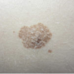 Tipi di nei e lesioni cutanee - AIM presso Melanoma Foundation