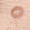 Types of Moles and Skin Lesions - AIM at Melanoma Foundation