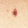 Tipos de lunares y lesiones en la piel - AIM en Melanoma Foundation