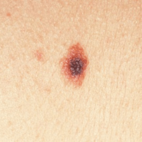 Types of Moles and Skin Lesions - AIM at Melanoma Foundation