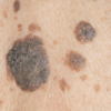 Types of Moles and Skin Lesions - AIM at Melanoma Foundation