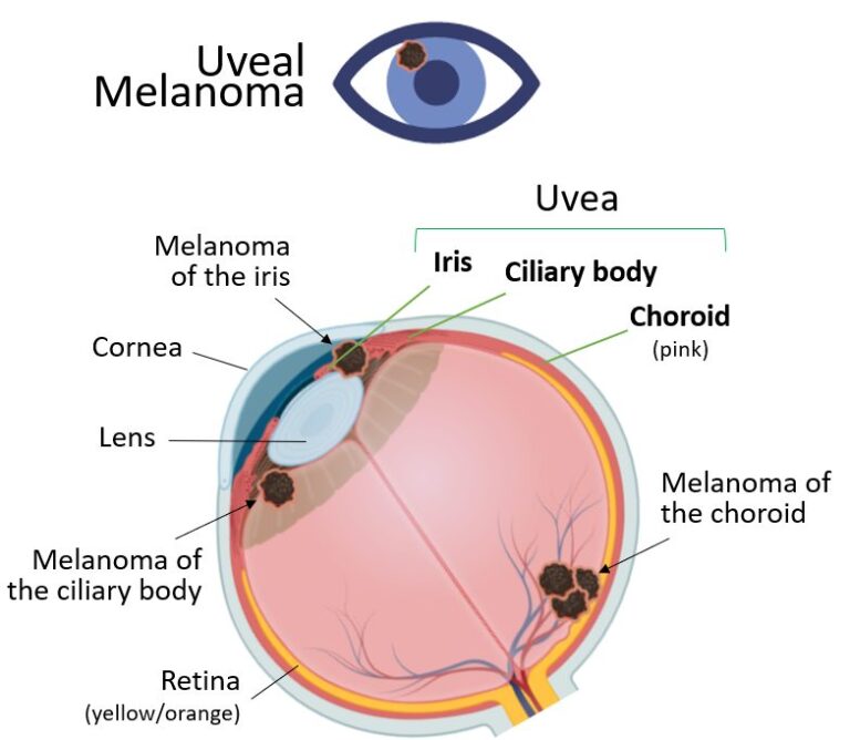 Bliższe spojrzenie na czerniaka błony naczyniowej oka – AIM w Melanoma ...