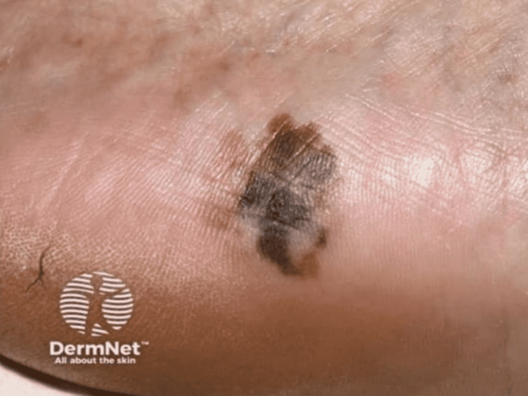 Images of Melanoma in People with Skin of Color - AIM at Melanoma ...