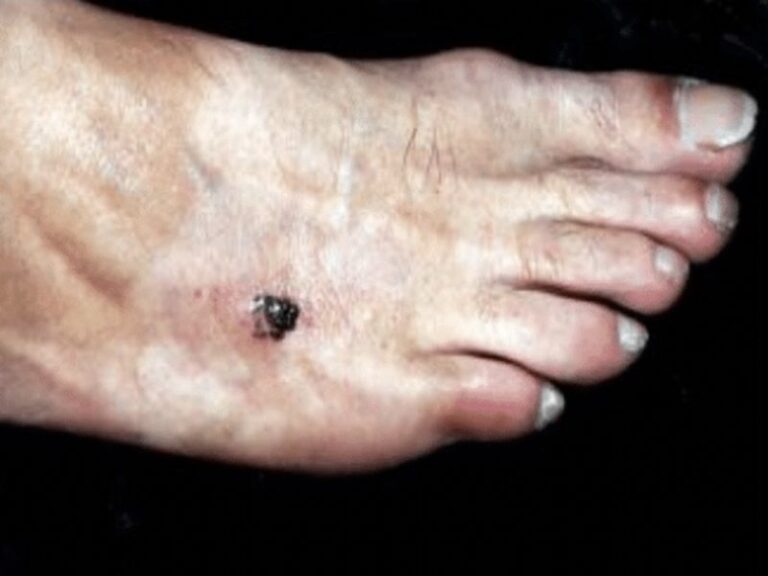 Images of Melanoma in People with Skin of Color - AIM at Melanoma ...