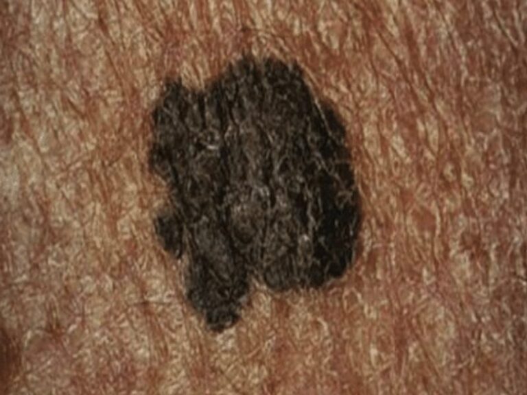 Images de mélanome chez les personnes de couleur de peau - AIM at ...