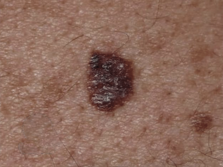Images of Melanoma in People with Skin of Color - AIM at Melanoma ...