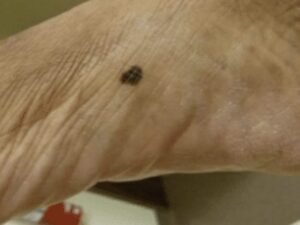 Images of Melanoma in People with Skin of Color - AIM at Melanoma ...
