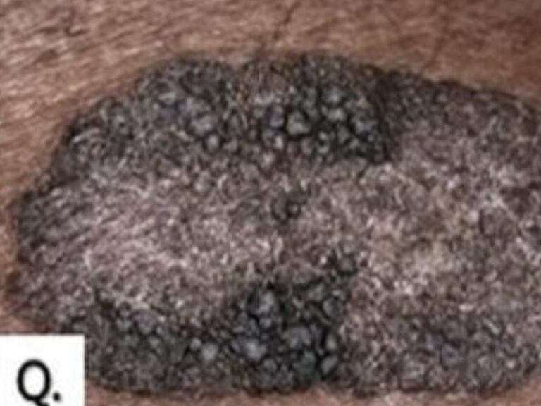 Images of Melanoma in People with Skin of Color - AIM at Melanoma ...