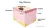 Stage 0 Melanoma (in situ) - AIM at Melanoma Foundation