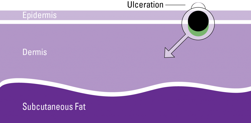 Stages of Melanoma - AIM at Melanoma Foundation