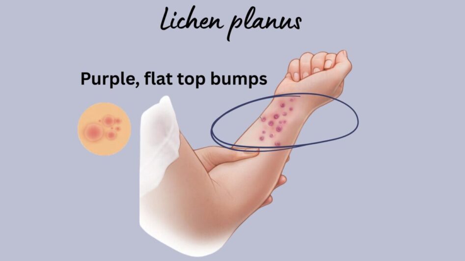 Zentrale Nebenwirkungen: Lichen ruber planus erklärt – AIM bei der ...