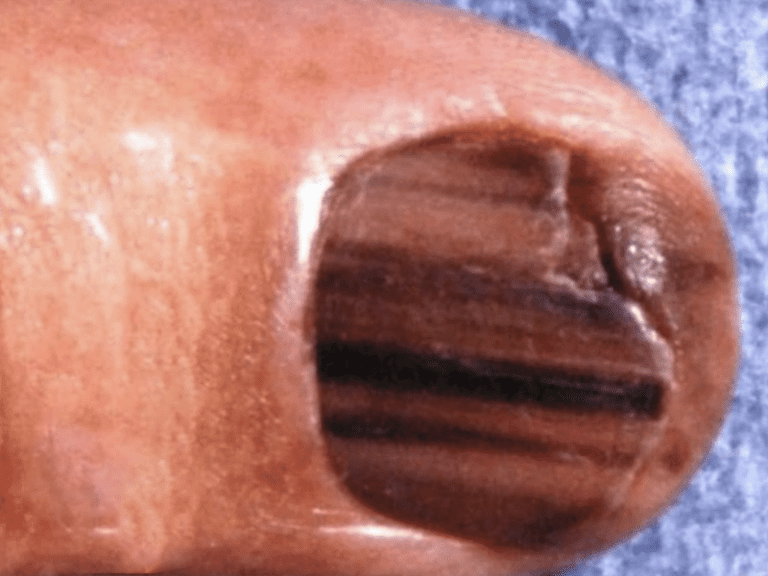 Images of Melanoma in People with Skin of Color - AIM at Melanoma ...